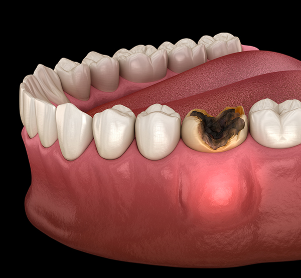 Tooth Abscess Buda TX | Buda Dental Specialty Group