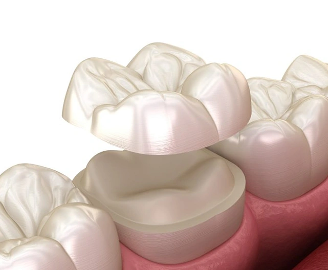 Onlays Buda TX | Buda Dental Specialty Group